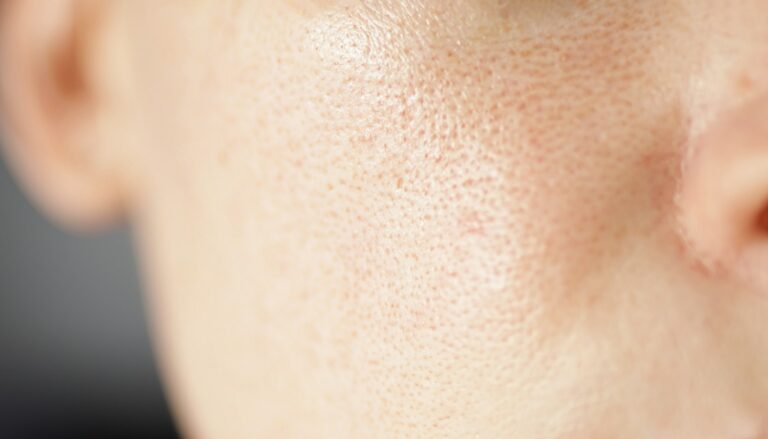 Light Spots On Skin (What It Means - How to Get Rid Of Them) | BeautyWayMag