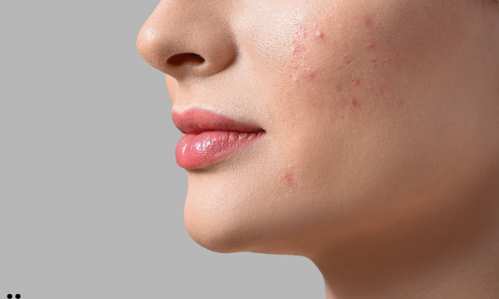 How to Get Rid of Clogged Pores By Yourself | BeautyWayMag