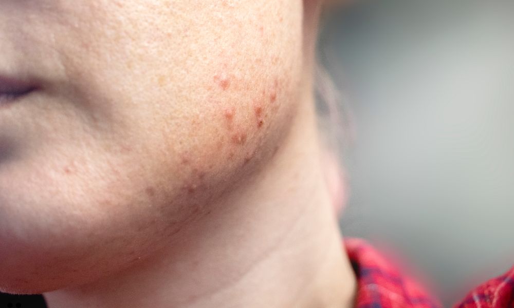 How to Get Rid of Tiny Bumps on Face | BeautyWayMag